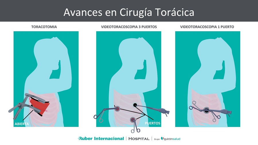 La resección sublobar de los nódulos pulmonares pequeños permite una ...