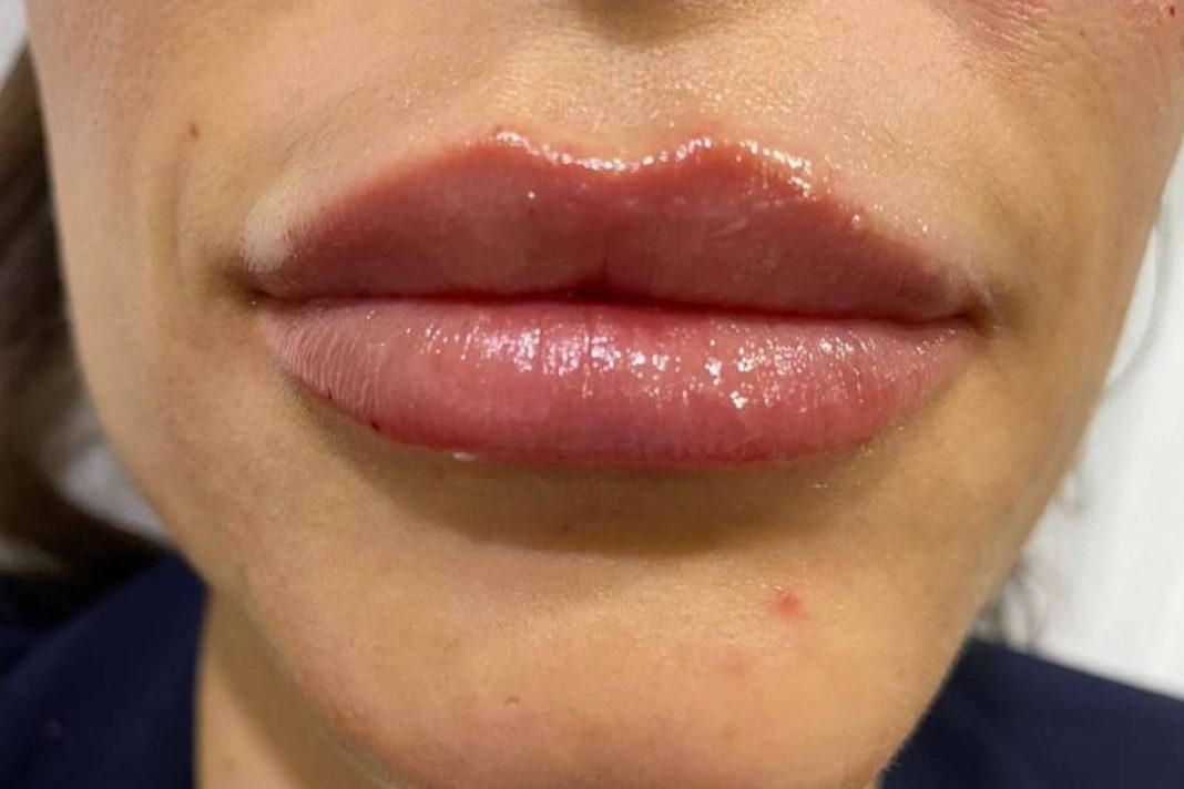 Rellenos de ácido hialurónico para la remodelación y aumento de labios