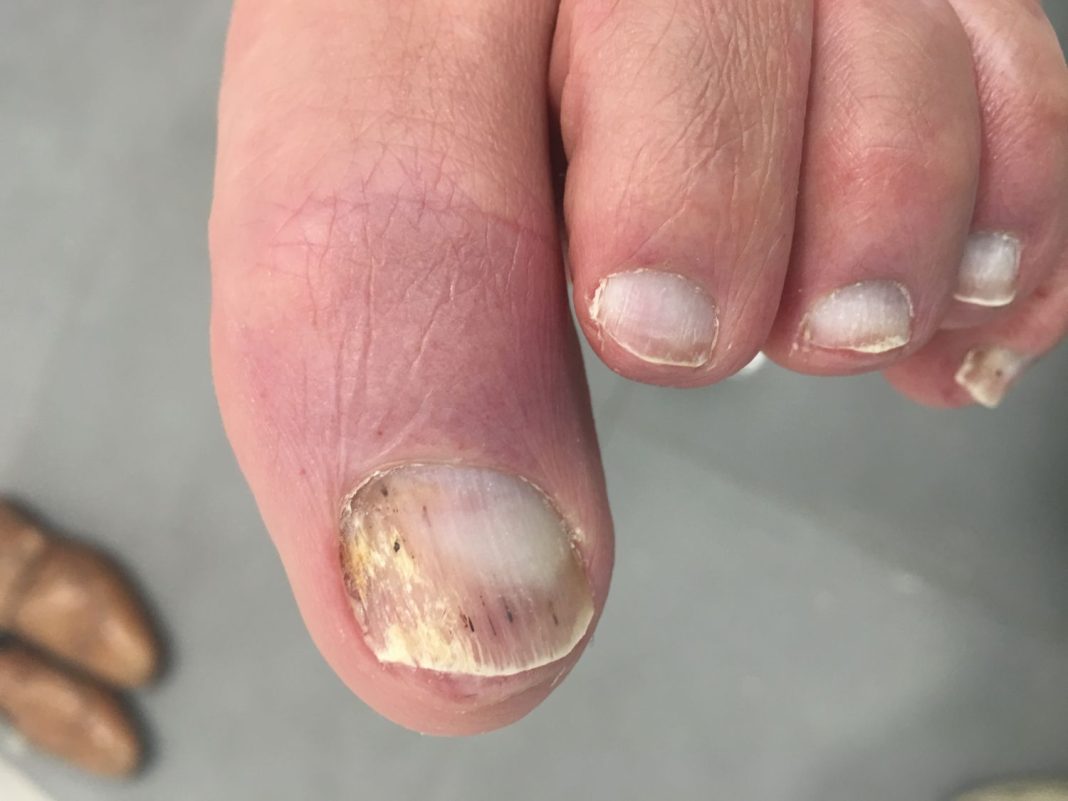 Este es el mejor método para librarte de los hongos de las uñas