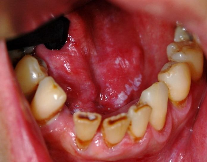 Alerta roja: las 6 señales de cáncer de boca que España está pasando por alto