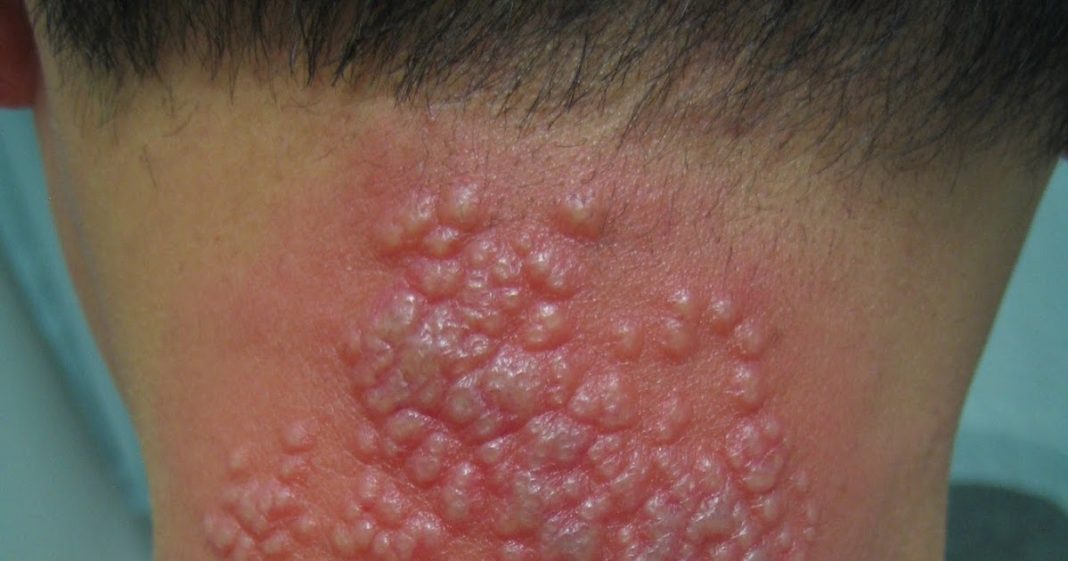 Herpes zóster: cómo identificarlo y cómo tratarlo